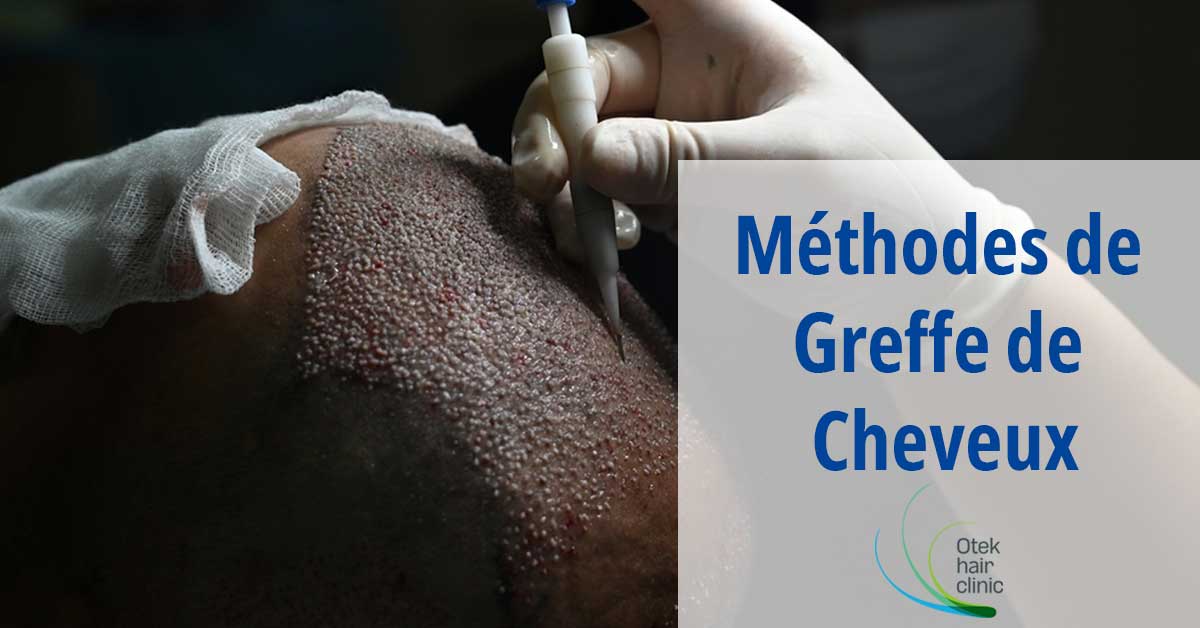 Méthodes de Greffe de Cheveux - Hair Transplant Antalya / Turkey - OTEK ...