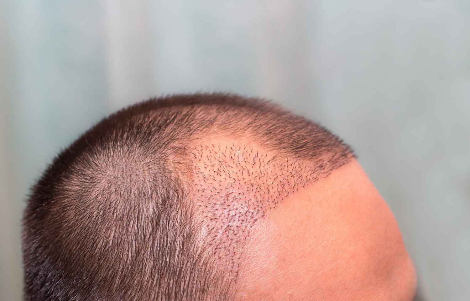 Unshaven Hair Transplantation - Hair Transplant Antalya/Turkey