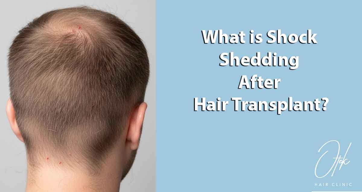 What is Shock Shedding After Hair Transplant? - Hair Transplant Antalya ...