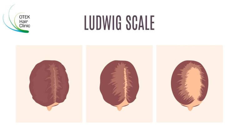 Understanding Female Pattern Baldness: Demystifying the Ludwig Scale ...